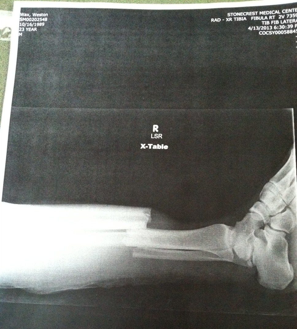 Brace Yourself for Suffering: Lessons from a Broken Leg