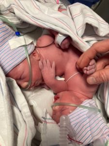 The Hard Blessing of Conjoined Twins